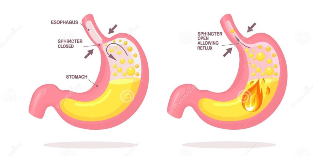 GASTROESOPHAGEAL REFLUX DISEASE (GERD)